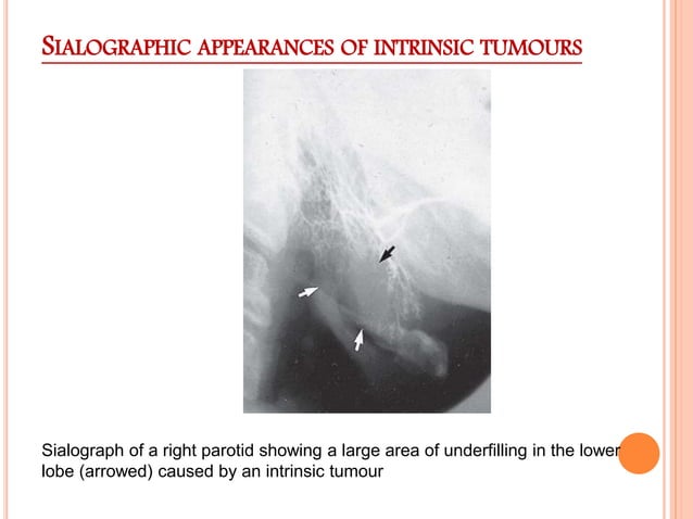 SIALOGRAPHY.pptx | Ear, Nose and Throat Conditions | Diseases and ...