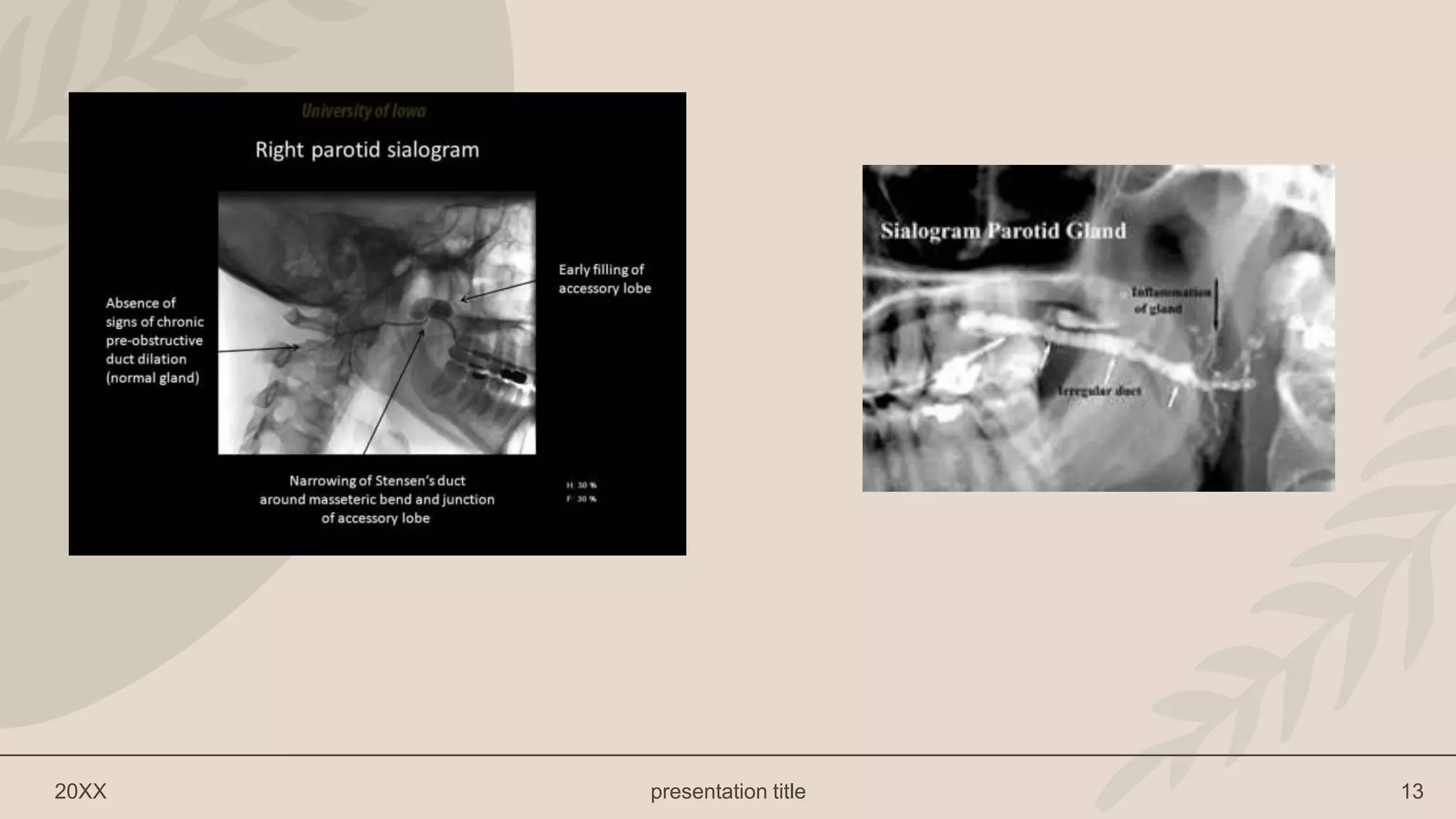 Sialography.pptx