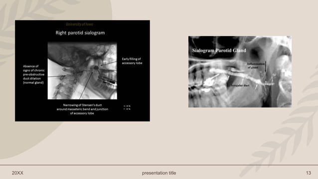 Sialography.pptx | Ear, Nose and Throat Conditions | Diseases and ...