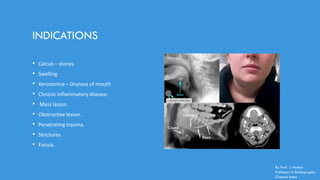 Sialography by Prof j venkat | PDF