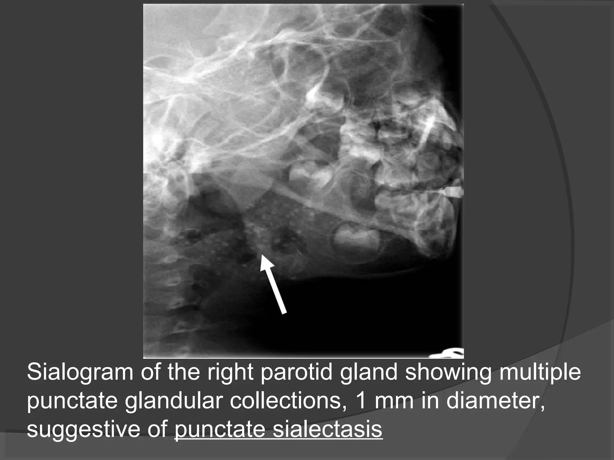 Sialography & dacrocystography | PPT