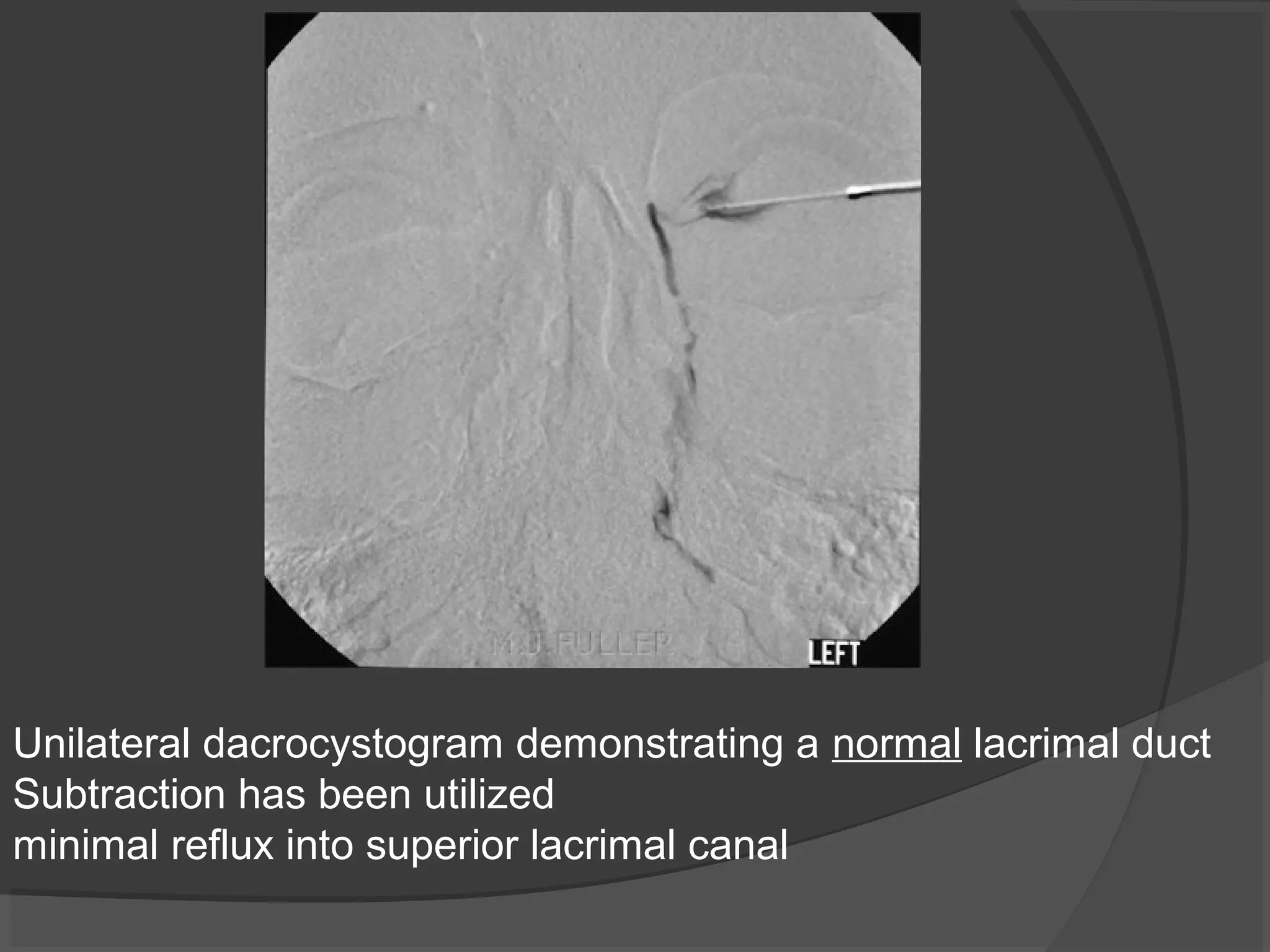 Sialography & dacrocystography | PPT