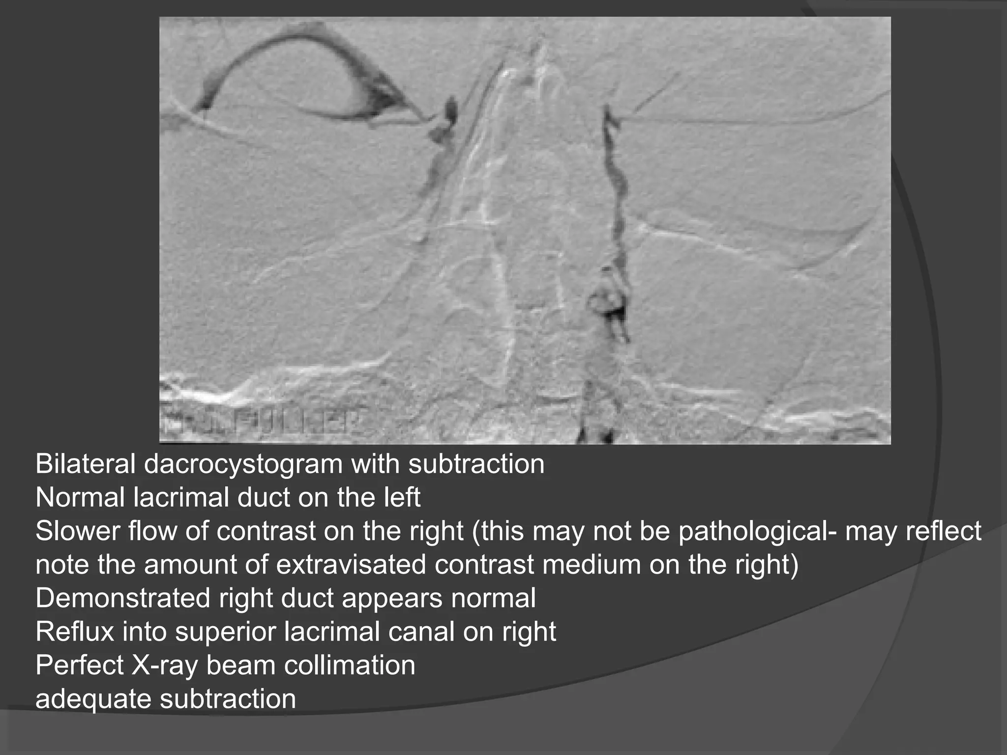 Sialography & dacrocystography | PPT