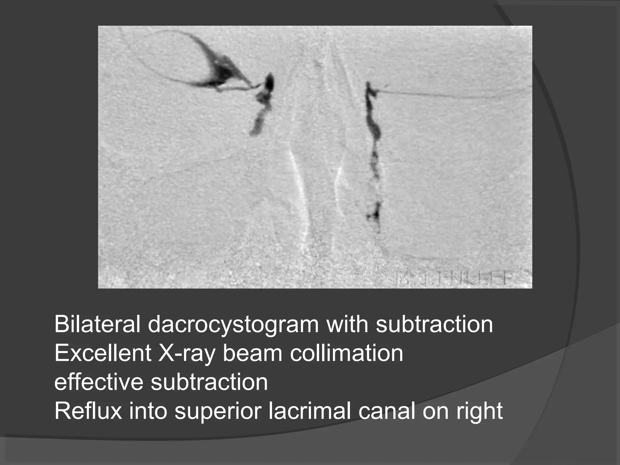 Sialography & dacrocystography | PPT