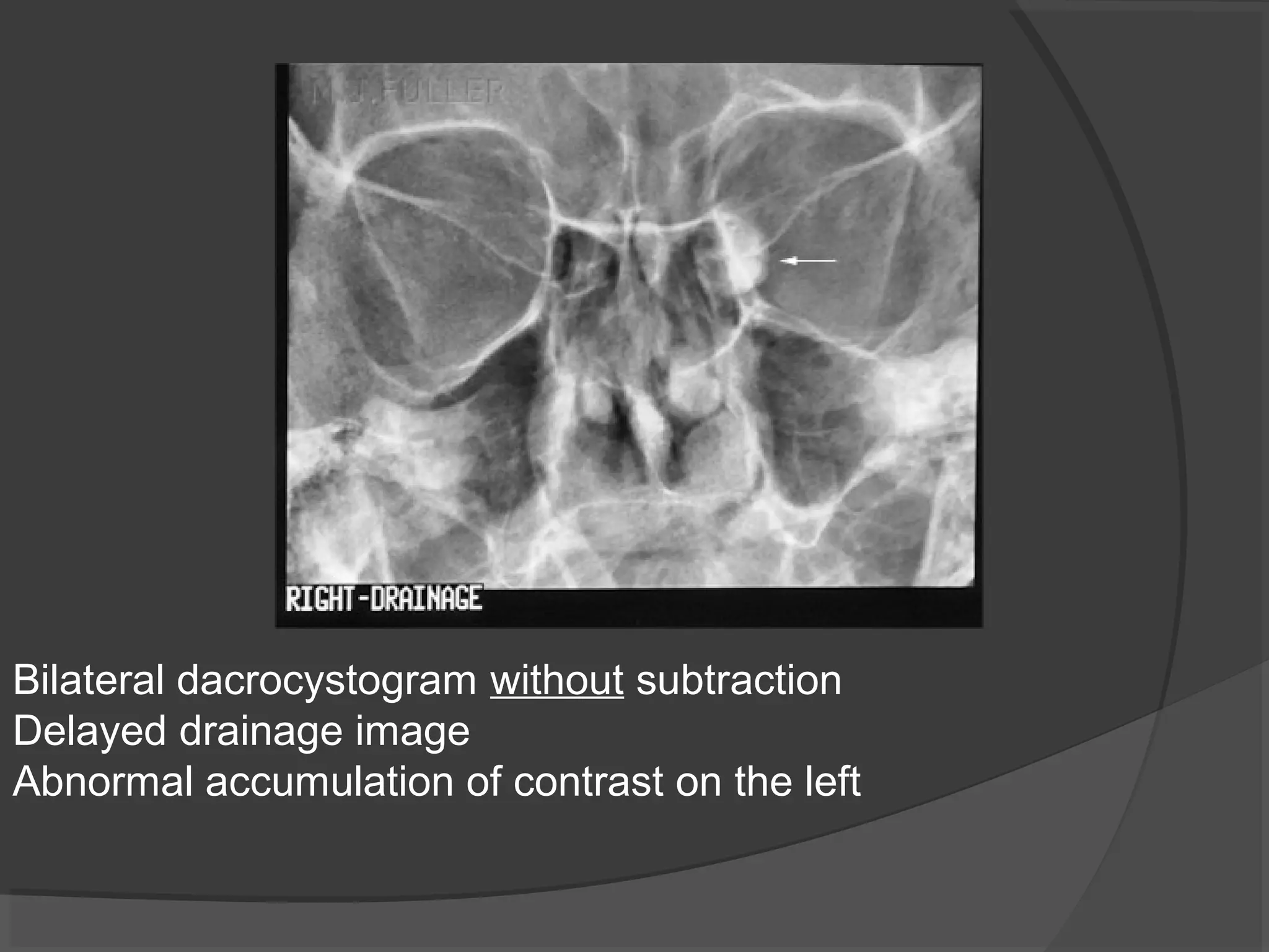 Sialography & dacrocystography | PPT
