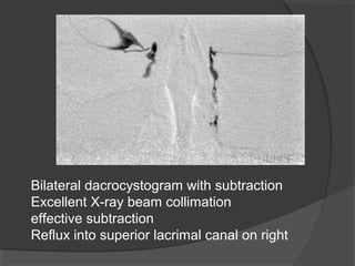 Sialography & dacrocystography | PPT