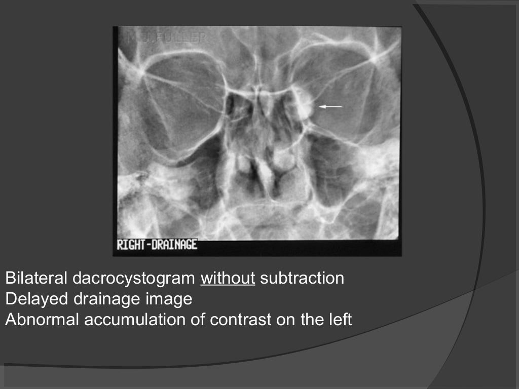 Sialography & dacrocystography