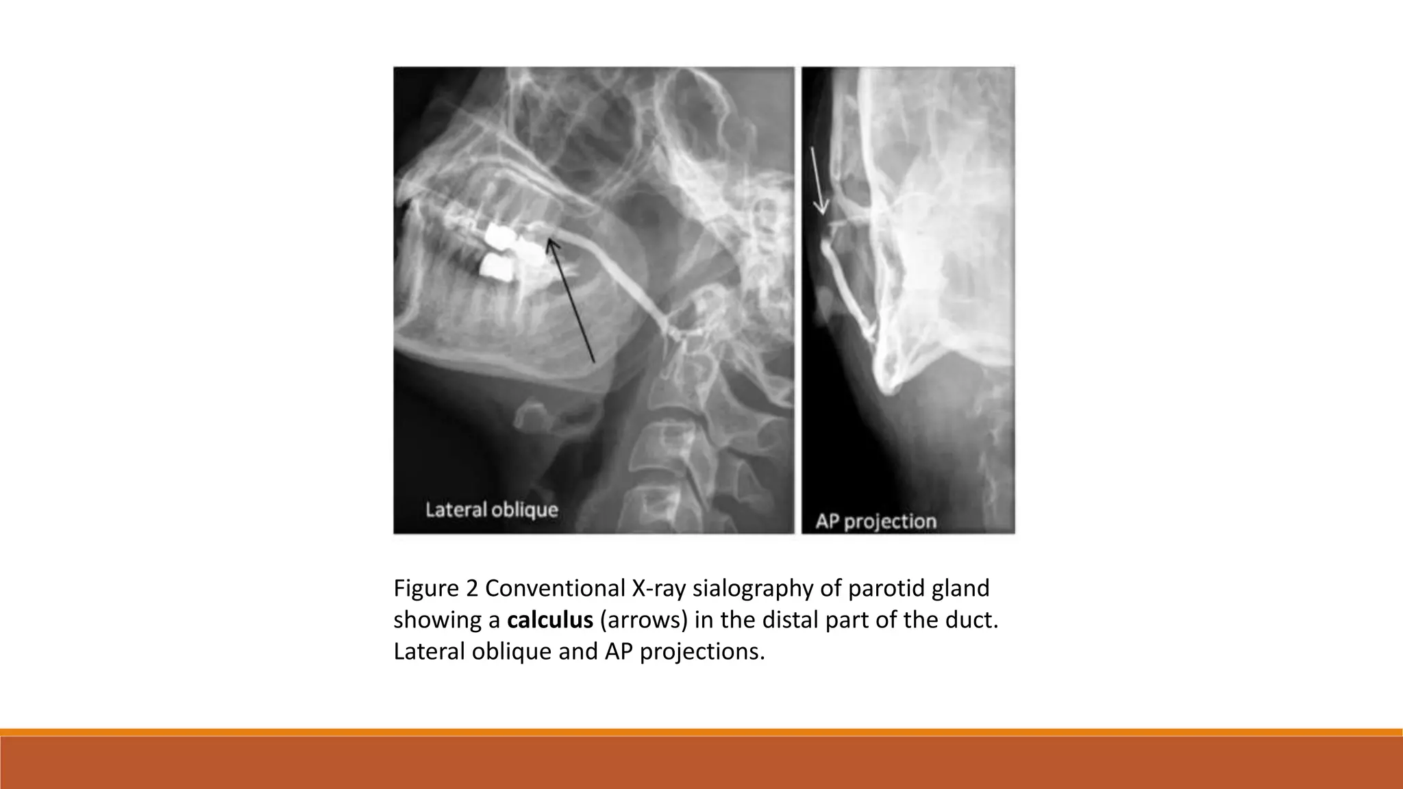Sialography & Dacrocystography | PPTX