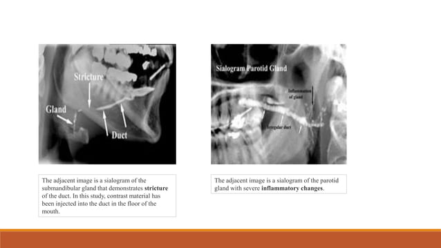 Sialography & Dacrocystography | PPTX | Ear, Nose and Throat Conditions ...