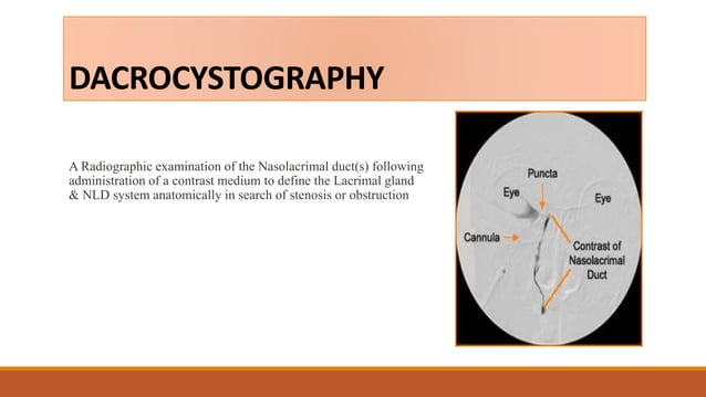 Sialography & Dacrocystography | PPTX | Ear, Nose and Throat Conditions ...