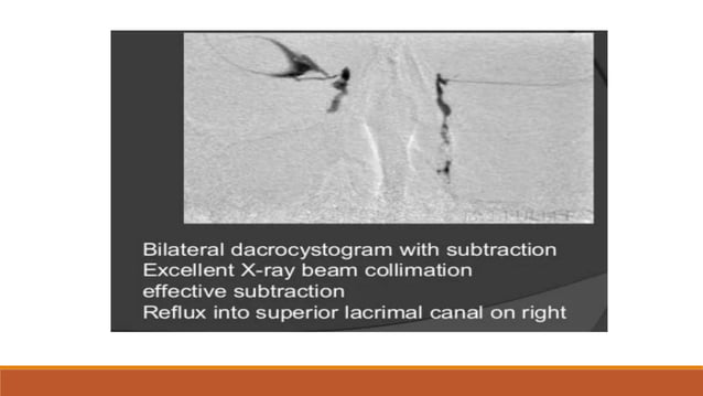 Sialography & Dacrocystography | PPTX | Ear, Nose and Throat Conditions ...