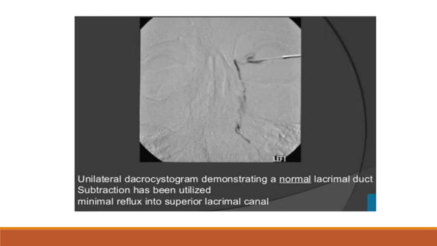 Sialography & Dacrocystography | PPTX | Ear, Nose and Throat Conditions ...
