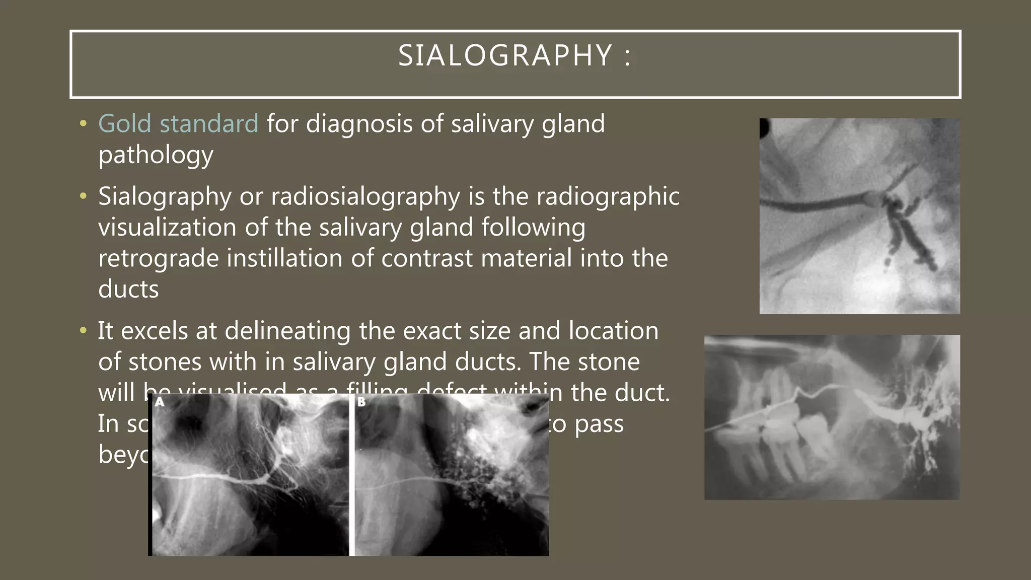 Sialolithiasis | PPTX