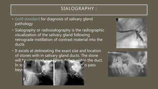 Sialolithiasis | PPTX