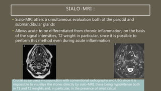 Sialolithiasis | PPTX