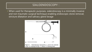 Sialolithiasis | PPTX