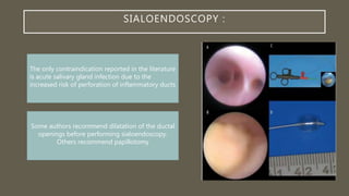 Sialolithiasis | PPTX