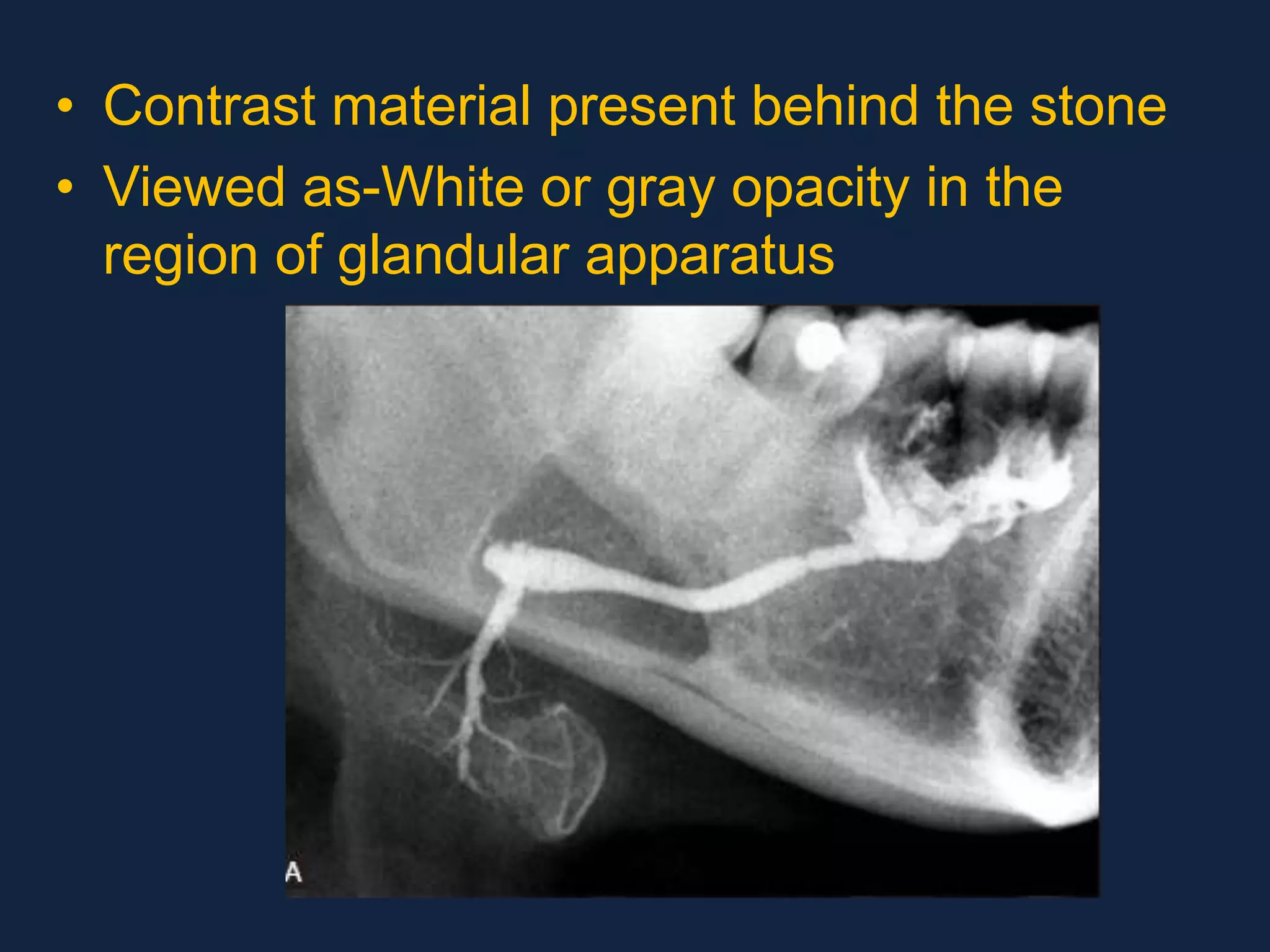 Sialolithiasis | PPTX