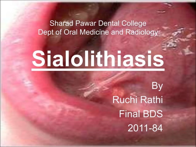 Sialolithiasis | PPTX