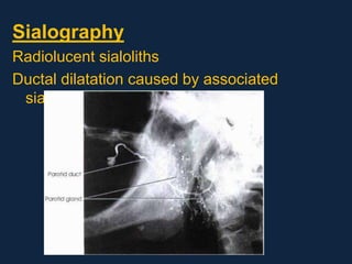 Sialolithiasis | PPTX