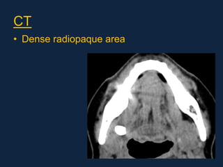 Sialolithiasis | PPTX