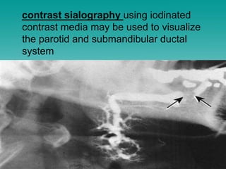 Sialolithiasis (exam oriented presentation) | PPTX