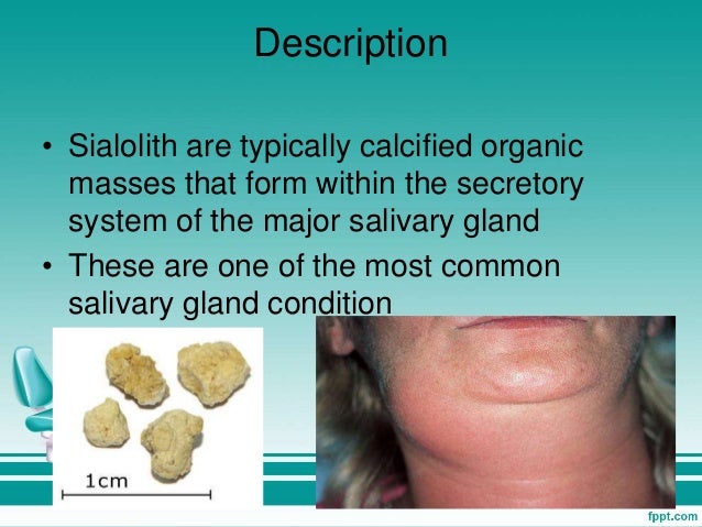 Sialolithiasis (exam oriented presentation)