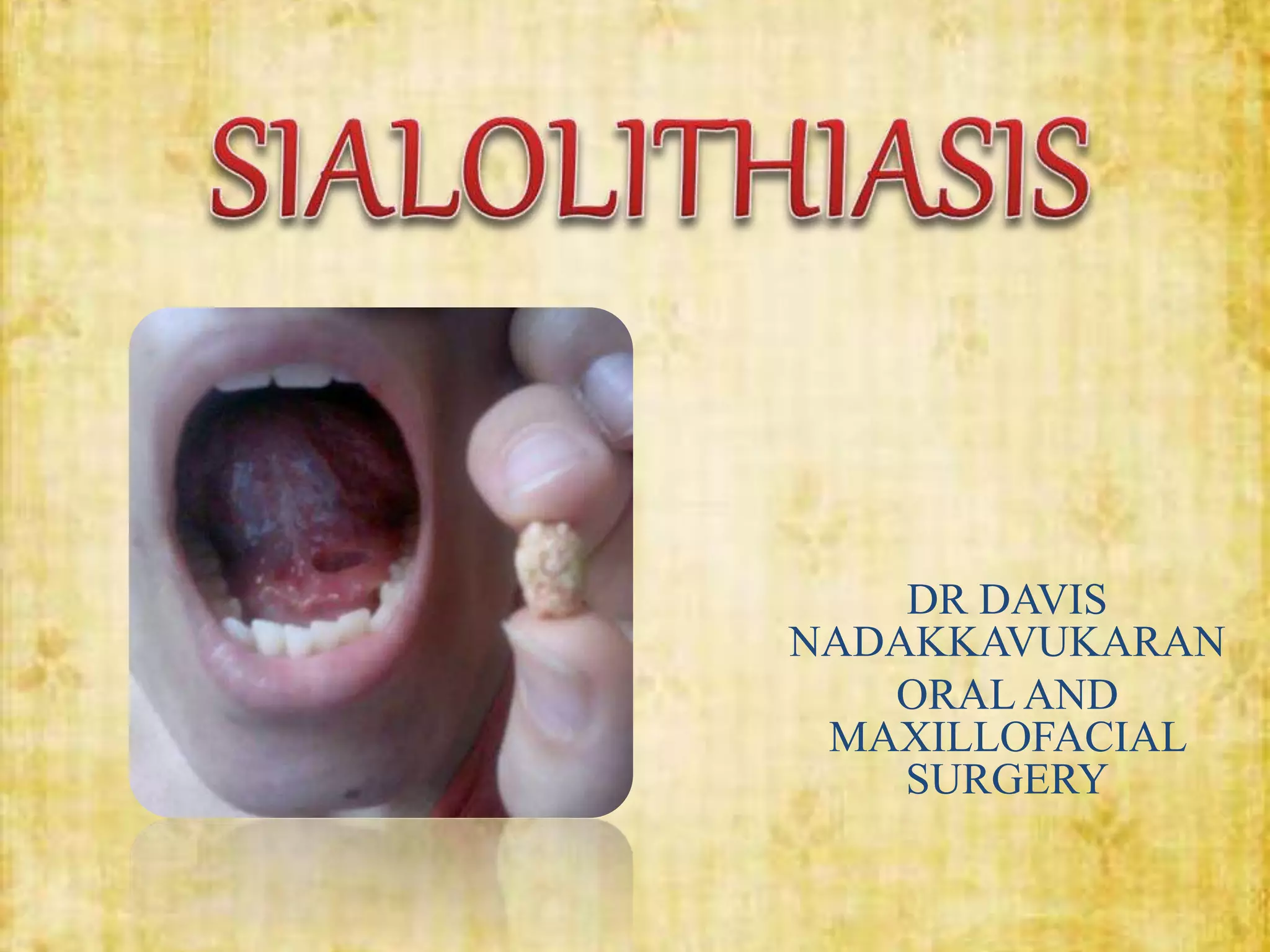 SIALOLITHIASIS - OMFS.pptx