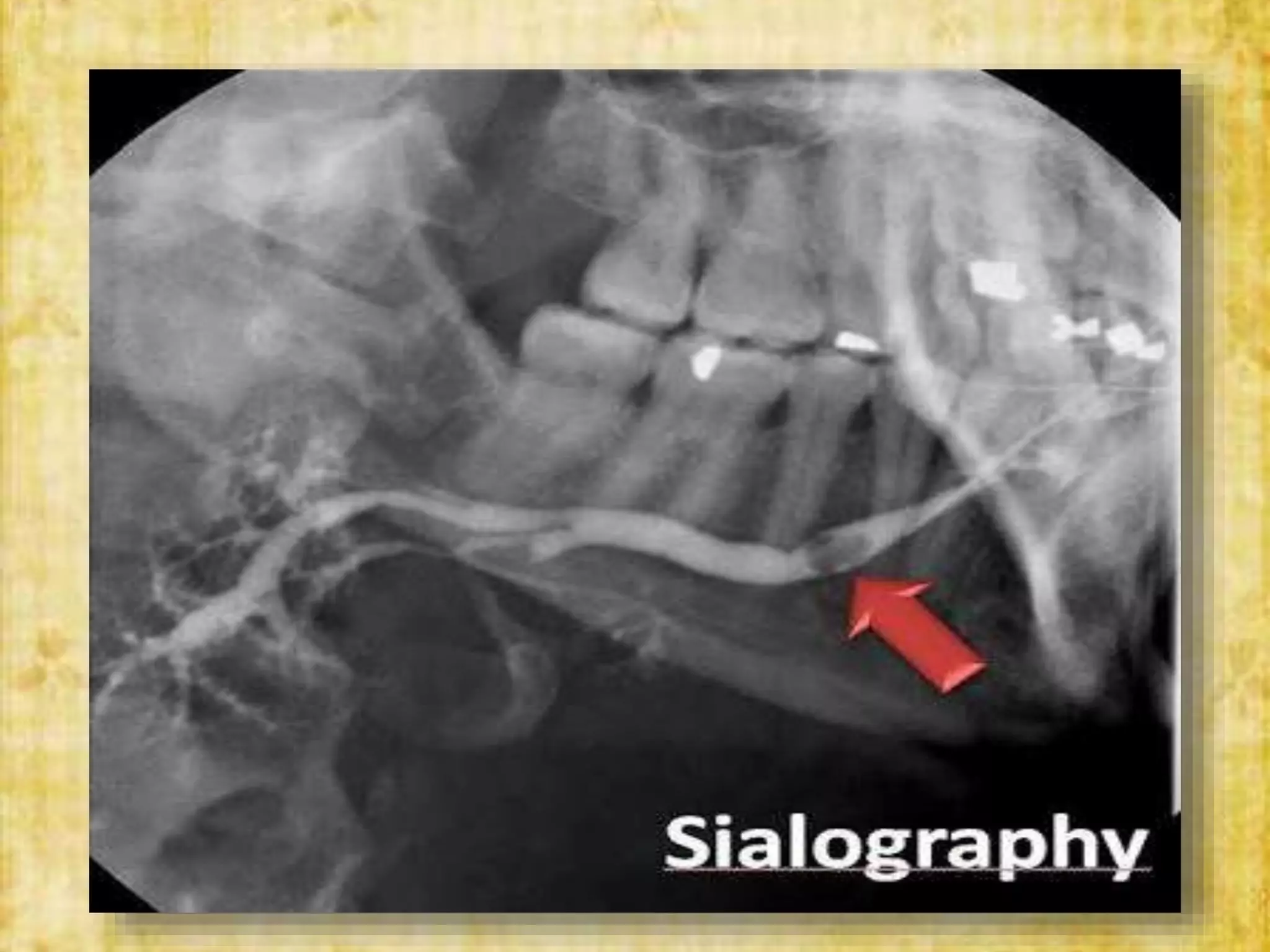 SIALOLITHIASIS - OMFS.pptx