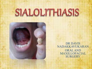 SIALOLITHIASIS - OMFS.pptx