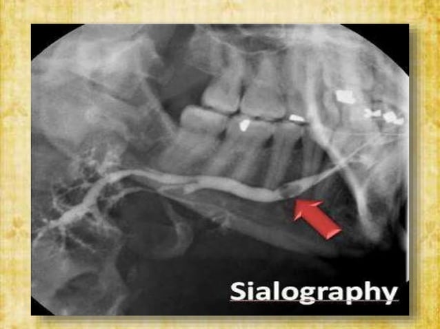 SIALOLITHIASIS - OMFS.pptx | Ear, Nose and Throat Conditions | Diseases ...
