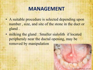 SIALOLITHIASIS - OMFS.pptx