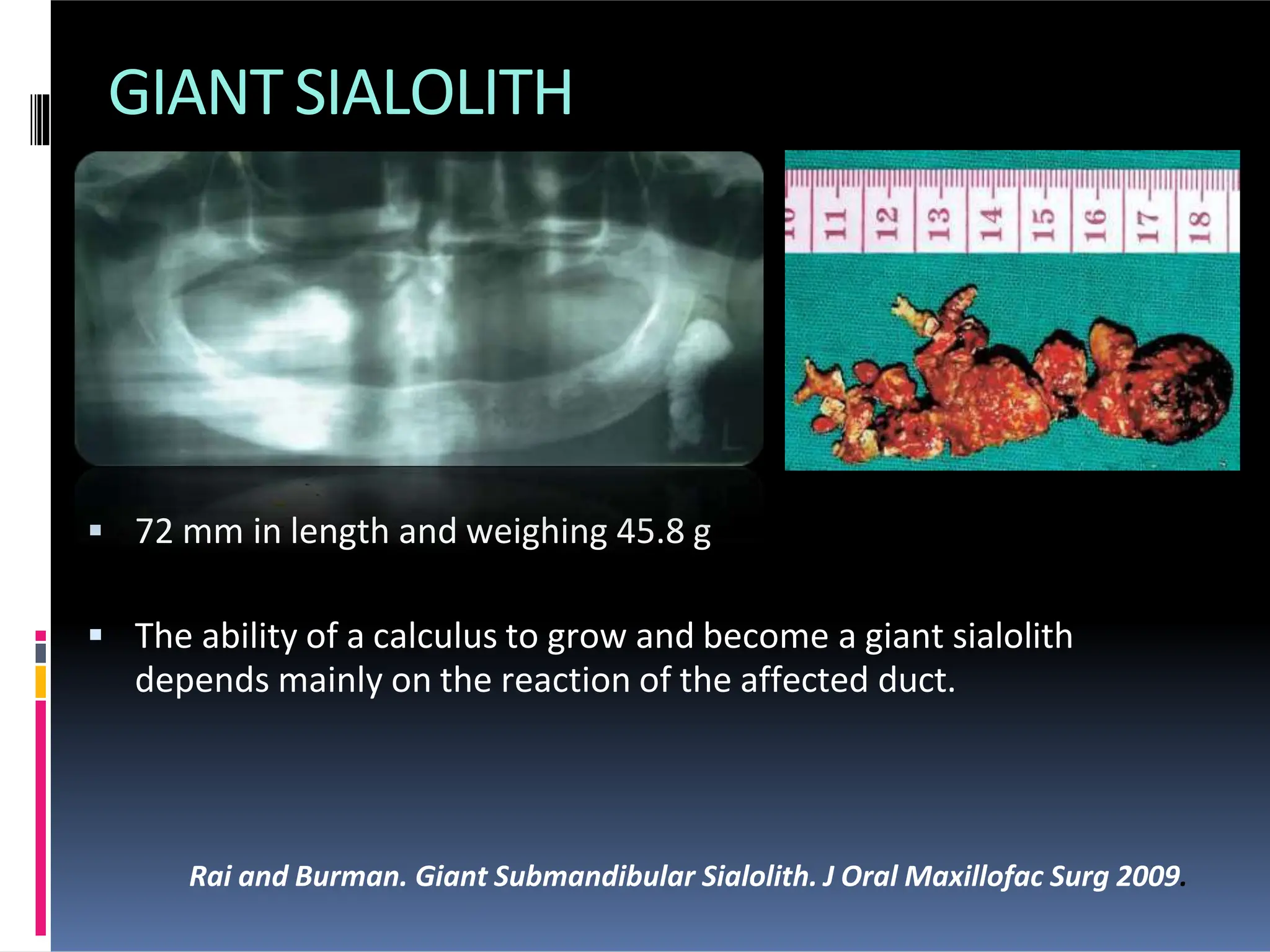 Causes,clinical features and treatment of Sialolithiasis | PPTX