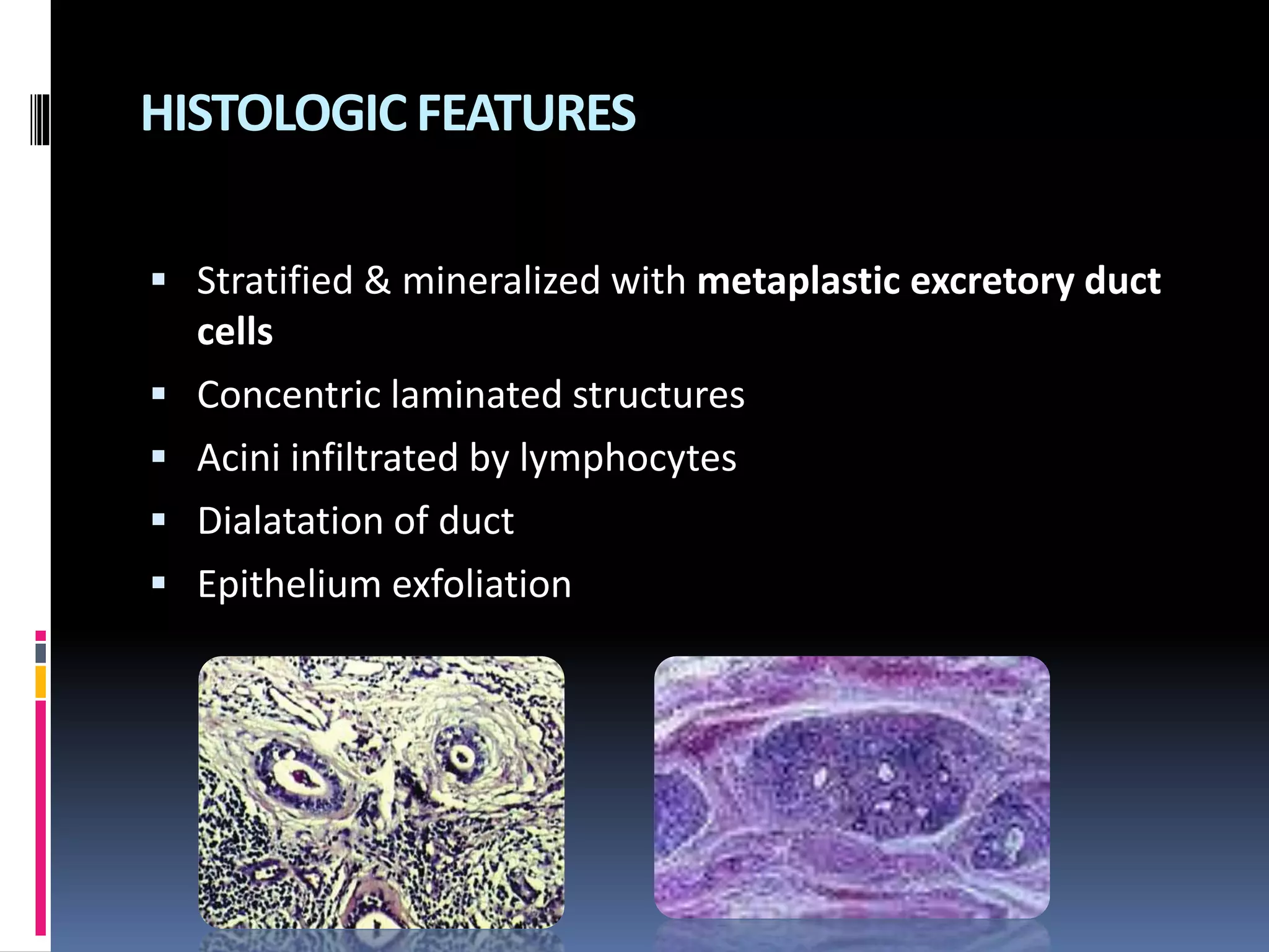 Sialolithiasis and its management in oral and maxillofacial surgery | PPTX