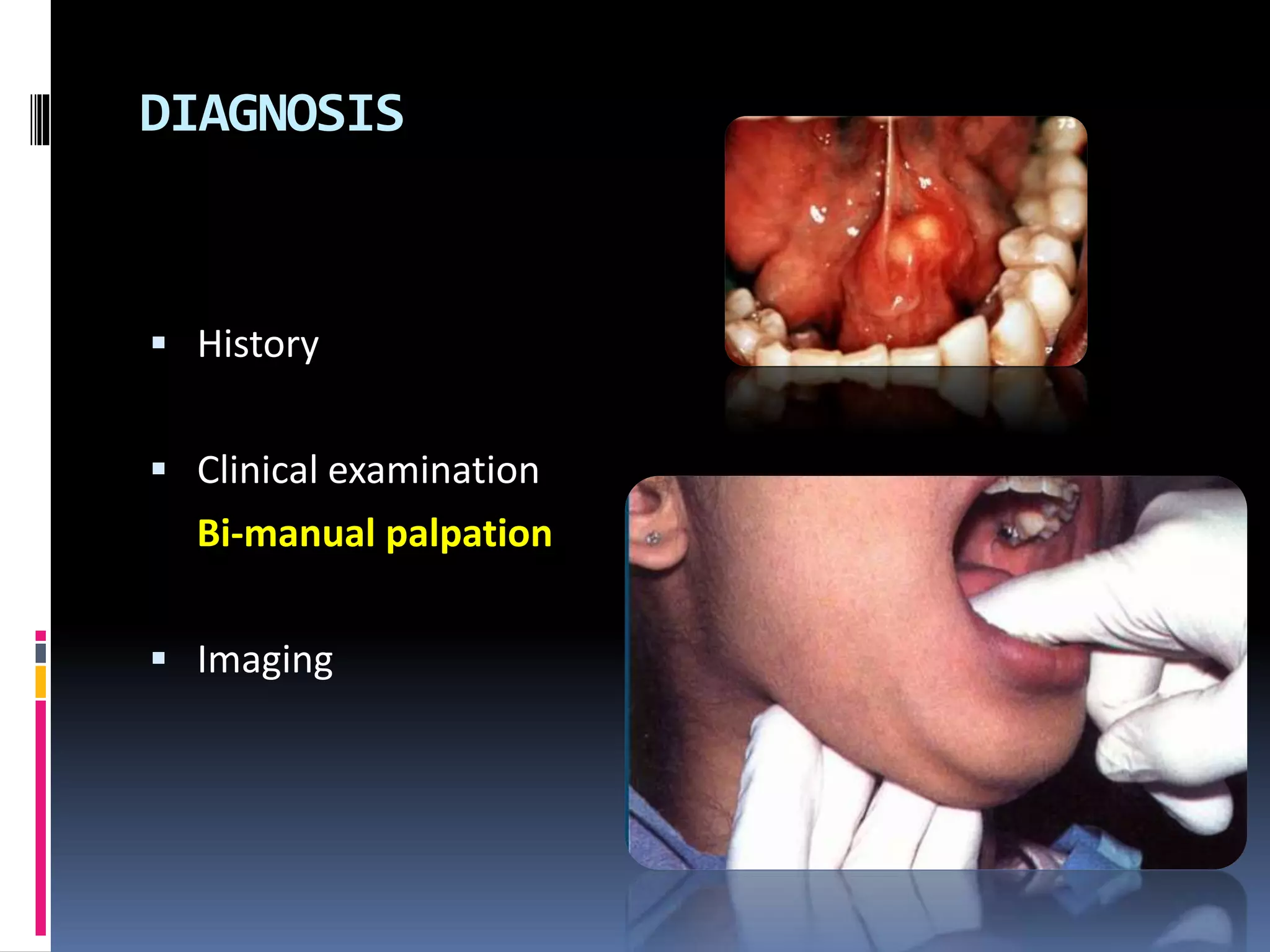 Sialolithiasis and its management in oral and maxillofacial surgery | PPTX