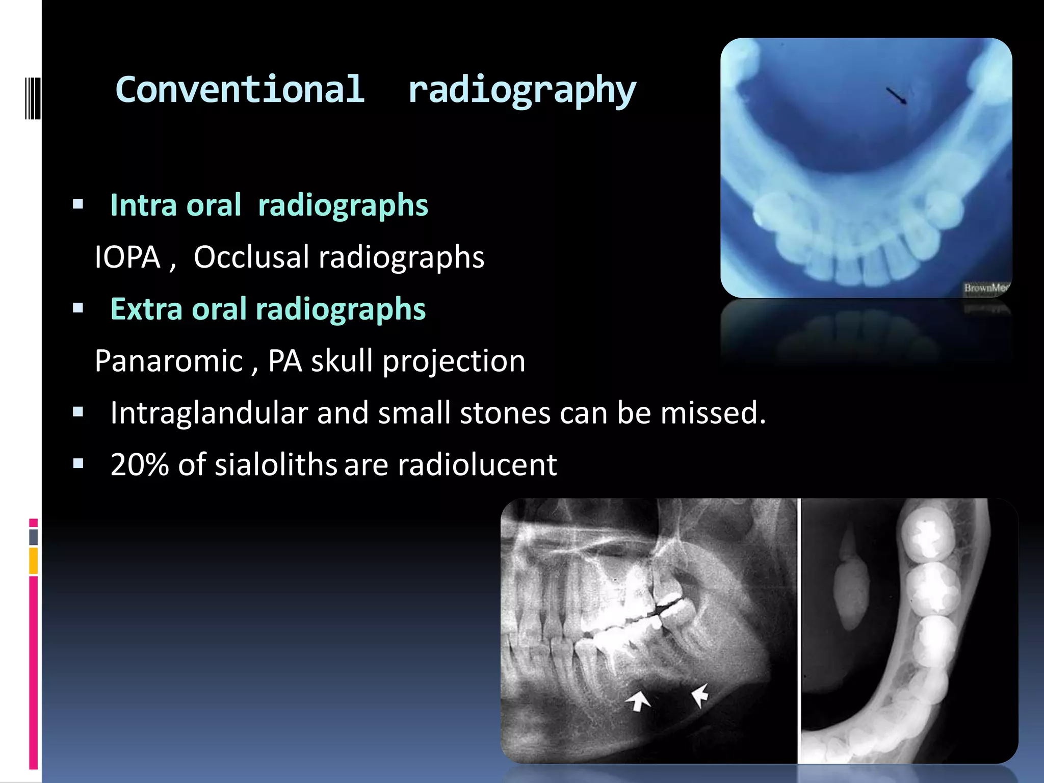 Sialolithiasis and its management in oral and maxillofacial surgery | PPTX