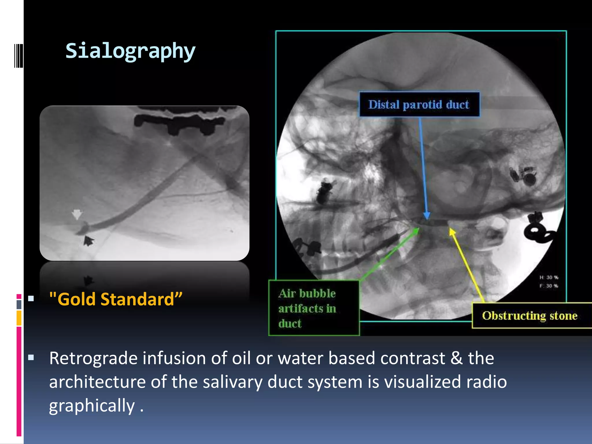 Sialolithiasis and its management in oral and maxillofacial surgery | PPTX