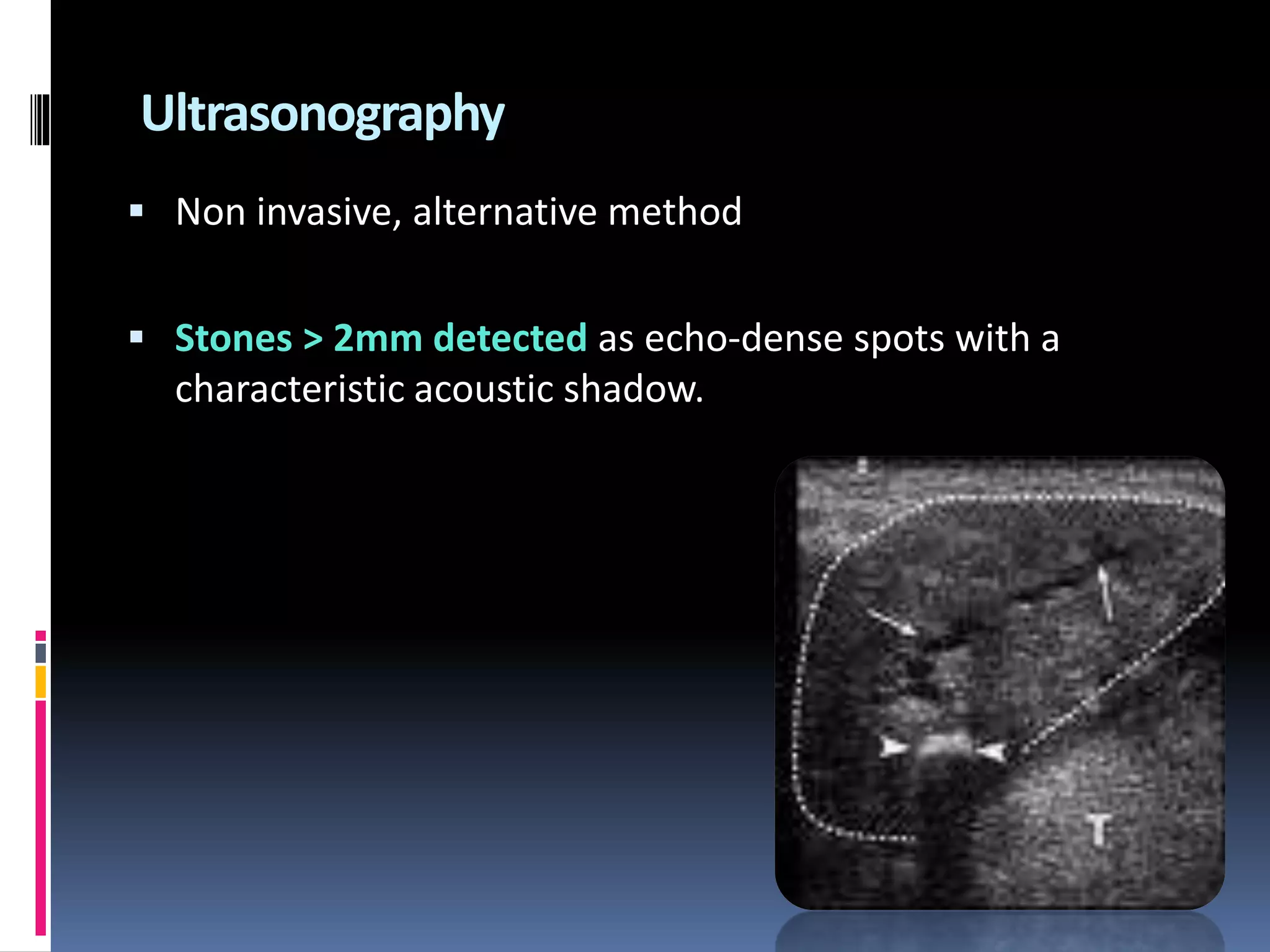 Sialolithiasis and its management in oral and maxillofacial surgery | PPTX