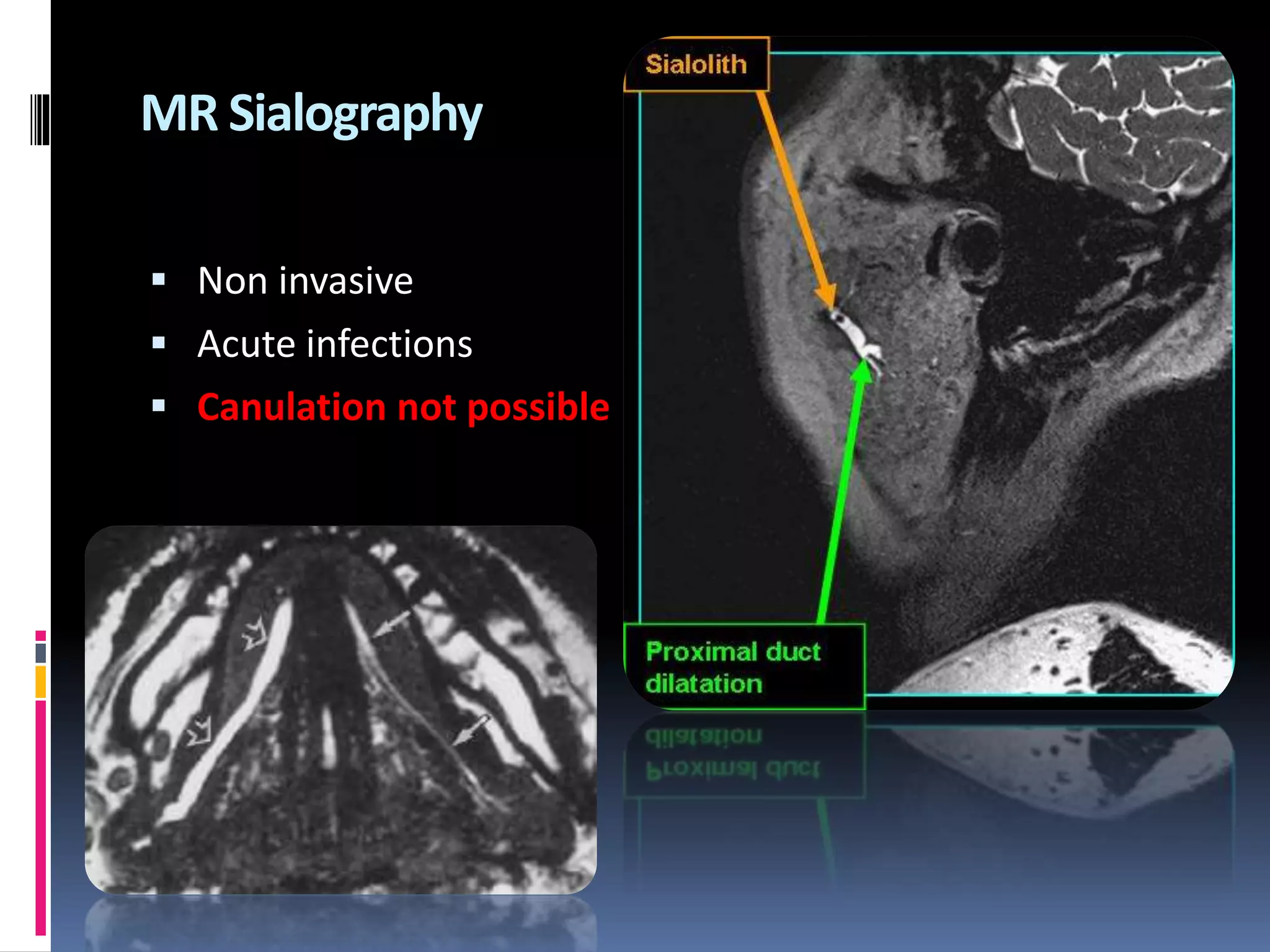 Sialolithiasis and its management in oral and maxillofacial surgery | PPTX