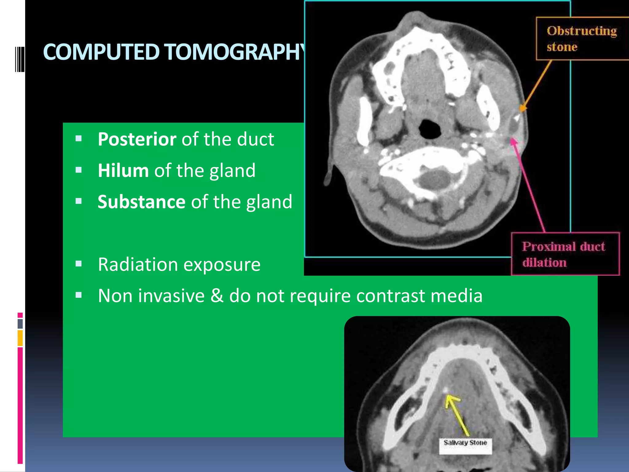Sialolithiasis and its management in oral and maxillofacial surgery | PPTX