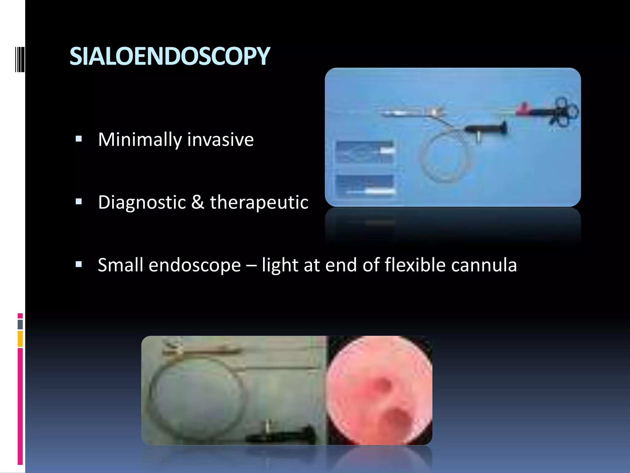 Sialolithiasis and its management in oral and maxillofacial surgery | PPTX