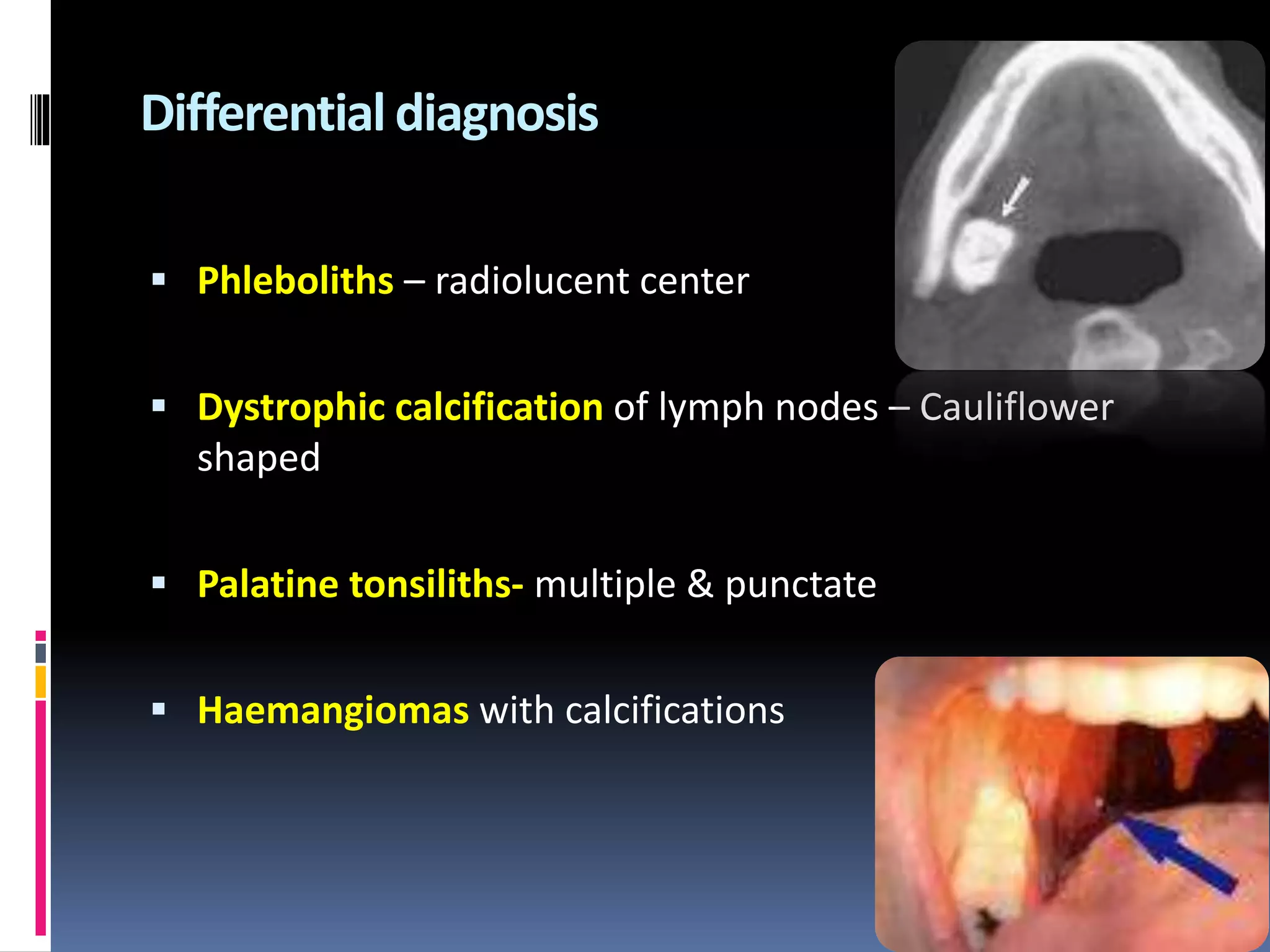 Sialolithiasis and its management in oral and maxillofacial surgery | PPTX