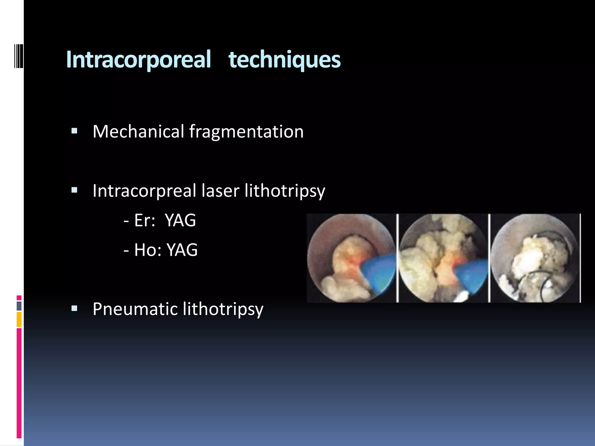 Sialolithiasis and its management in oral and maxillofacial surgery | PPTX