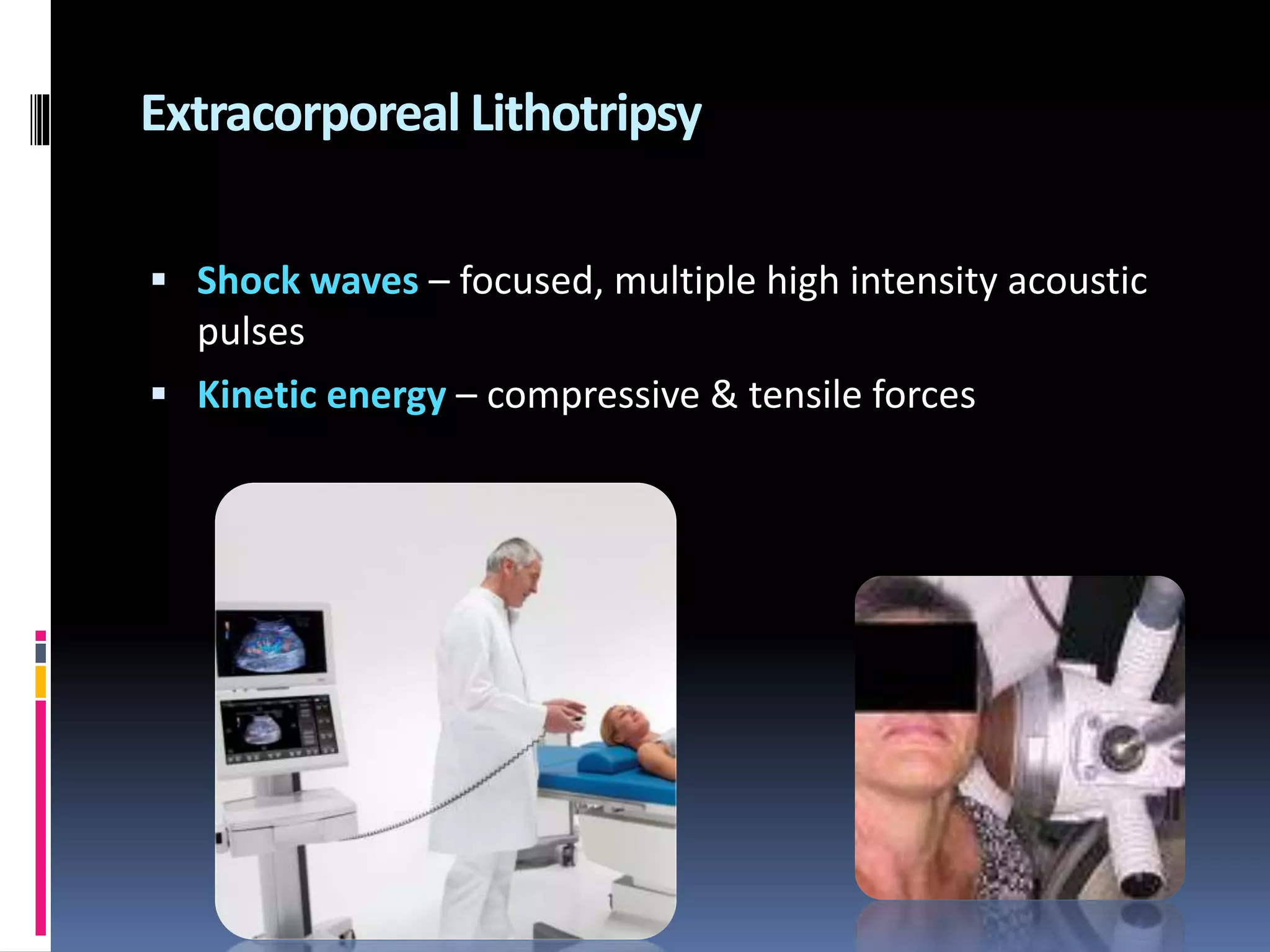 Sialolithiasis and its management in oral and maxillofacial surgery | PPTX