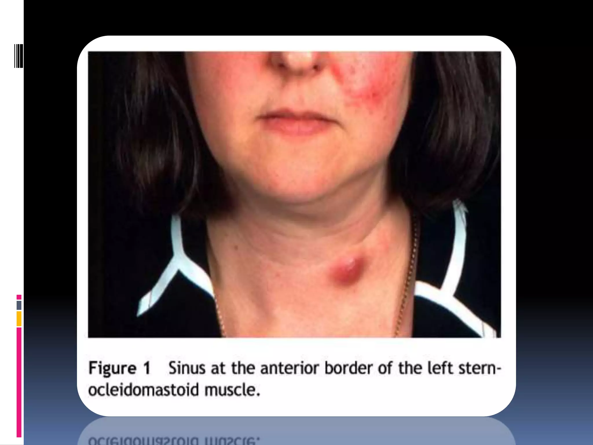 Sialolithiasis and its management in oral and maxillofacial surgery | PPTX