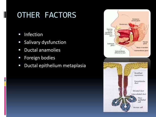 Sialolithiasis and its management in oral and maxillofacial surgery | PPTX