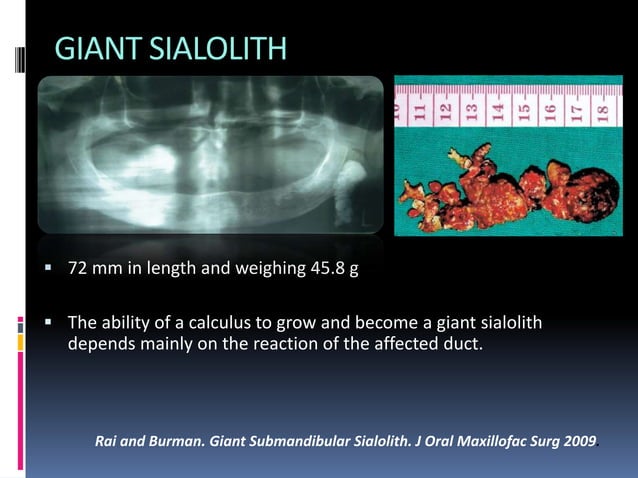 Sialolithiasis and its management in oral and maxillofacial surgery | PPTX