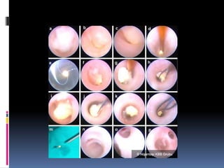 Sialolithiasis and its management in oral and maxillofacial surgery | PPTX