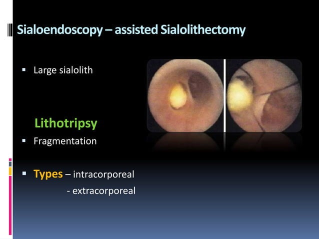 Sialolithiasis and its management in oral and maxillofacial surgery | PPTX