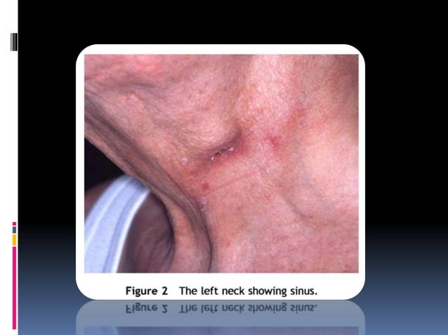 Sialolithiasis and its management in oral and maxillofacial surgery | PPTX